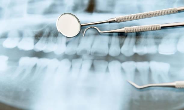 Intraoral Periapical Radiograph (IOPA) | Dental X-Ray in Pune